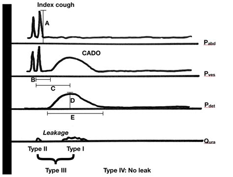 Cough Associated Detrusor Overactivity Cado