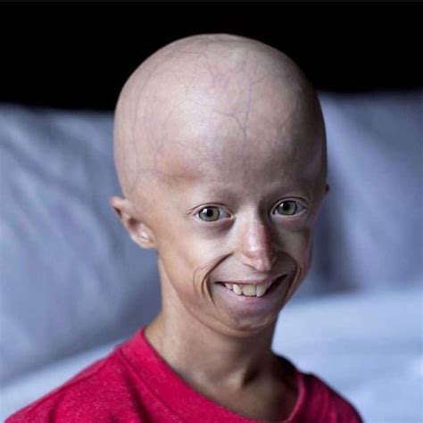 Progeria Syndrome Medizzy
