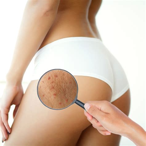 Butt Acne And Other Causes Of Butt Pimples Wype