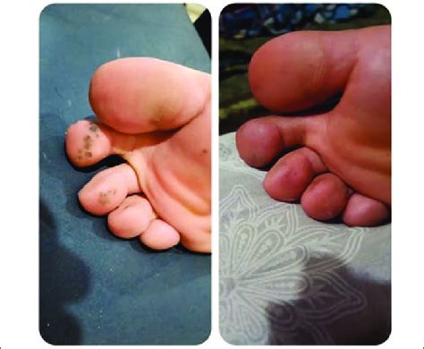 Complete Clearance Of Warts After The 4th Session Of Intralesional