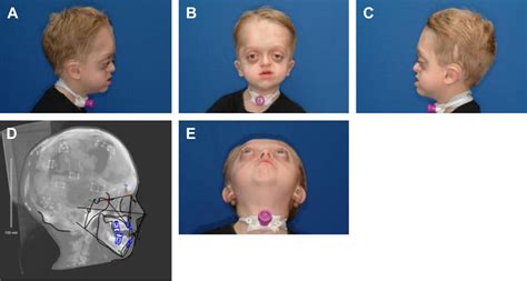 Subcranial Midface Advancement In Patients With Syndromic