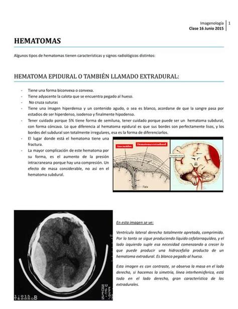 Resúmenes De Tipos De Hematomas Descarga Apuntes De Tipos De Hematomas