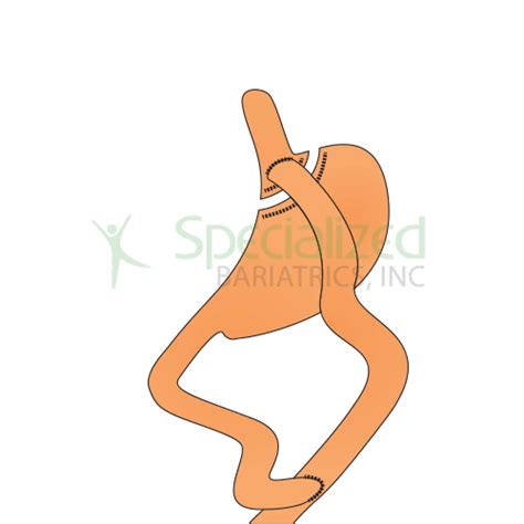 Gastric Bypass Surgery In Mexico Specialized Bariatrics Inc