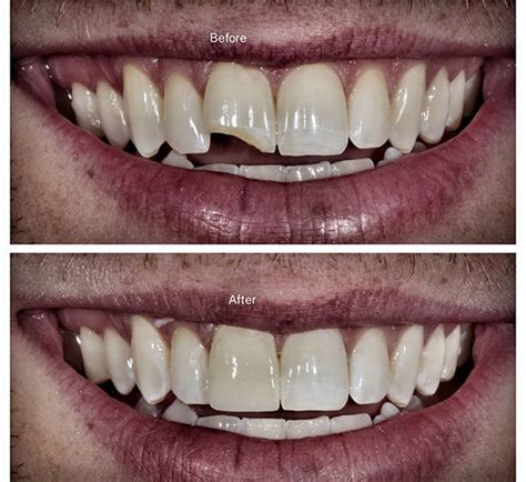 Dental Filling Front Teeth