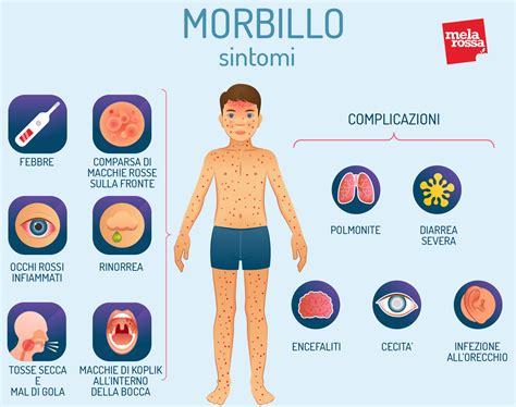 Morbillo Cosè Cause Sintomi Diagnosi Decorso Cure E Prevenzione