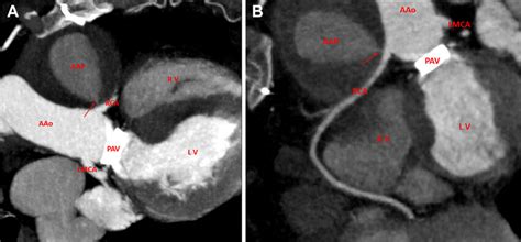 Coronary Computed Tomography Angiogram Download Scientific Diagram