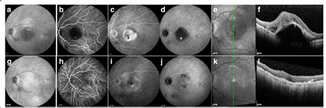 Intravitreal Aflibercept Treatment For Rap Case 3 A 59 Year Old Download Scientific Diagram