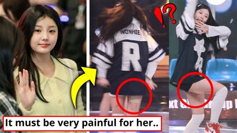 Wonhee Illit Raises Concerns After Photos Of Her Legs Condition Were