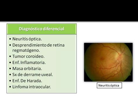Epiescleritis Y Escleritis Pptx