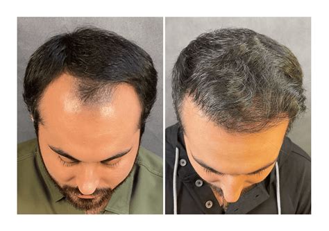 Hair Transplant Beforeafter Results For Men Bosley Hair Transplant