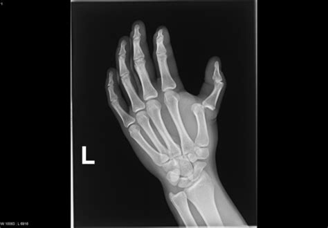 Dislocation Of Thumb X Ray Radrounds Radiology Network