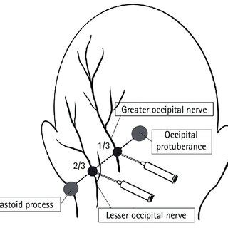 Distribution Of Occipital Nerve Download Scientific Diagram
