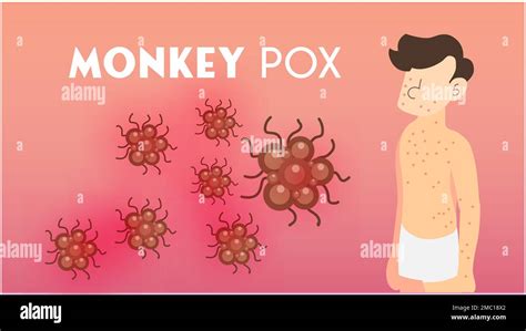 Illustration Of Monkeypox Virus Vector Of A Person With Monkeypox