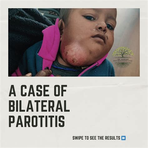 Another One Of My Cases A Case Of Bilateral Parotitis As I
