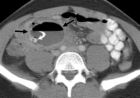 Percutaneous Abscess Drainage In Patients With Perforated Acute Appendicitis Effectiveness