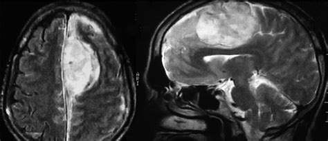 Occult Falcine Meningioma Unmasked Following Nearly Complete Hemorrhagic Transformation With
