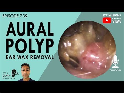 739 Infected Aural Polyp Ear Wax Removal Youtube