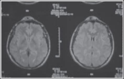 Mri Revealed Subcutaneous Mass At Midline Of The Forehead Has