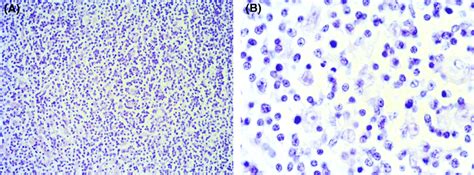 Hande Staining Of The Right Cervical Lymph Node A 100× Magnification