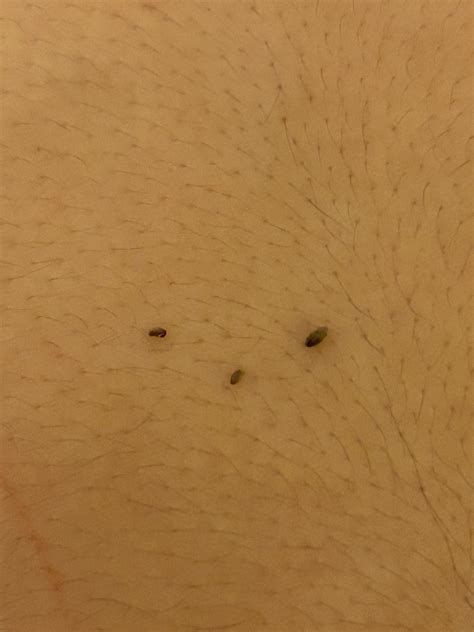 男友的該邊粉刺 粉刺愛好者板 Dcard