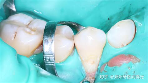 蛀牙的龋坏范围到牙龈下了，手术翻瓣，树脂充填补牙 知乎