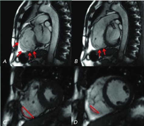 Cardiac Mri Of A Patient With Arvd Own Data Bright Blood Images In