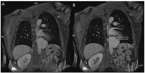 Behçets Disease A Radiological Review Of Vascular And Parenchymal