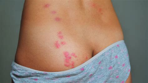 How To Get Rid Of Bed Bug Bites Overnight