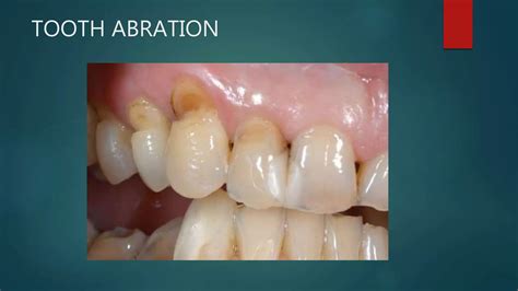 Non Carious Lesion Pptx