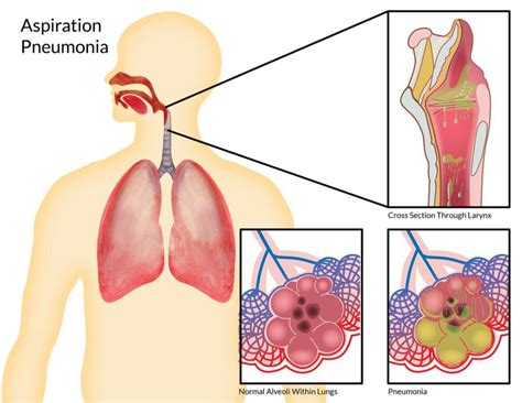 Pneumonia Aspirasi Penyebab Gejala Penanganan Pencegahan Dan Dokter