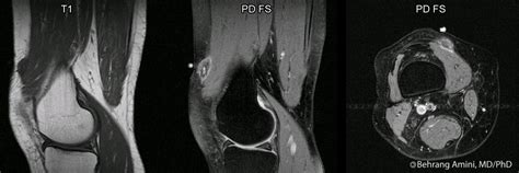 Roentgen Ray Reader Myxoinflammatory Fibroblastic Sarcoma
