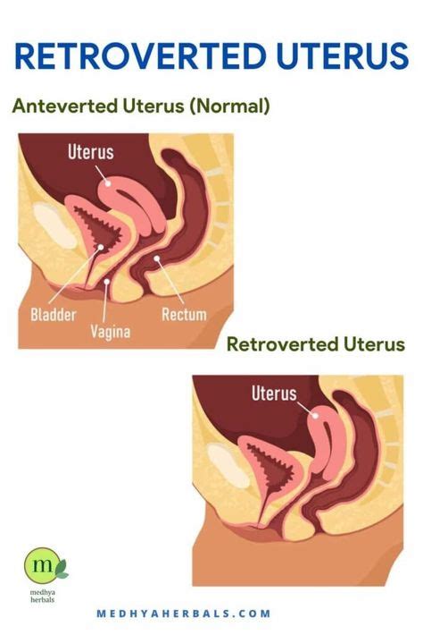 Inverted Uterus Diagram