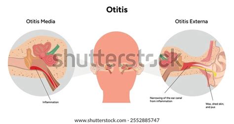 Otitis Media Externa Inflammation Anatomy Human Stock Vector Royalty