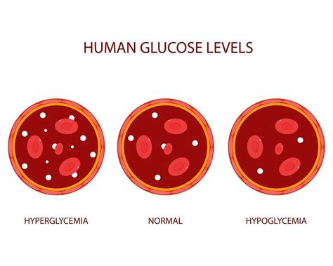 Hyperglycemia Vector Art Icons And Graphics For Free Download