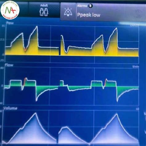 Algorithm Cài đặt Máy Thở Ban đầu Cho Bệnh Nhân Ards