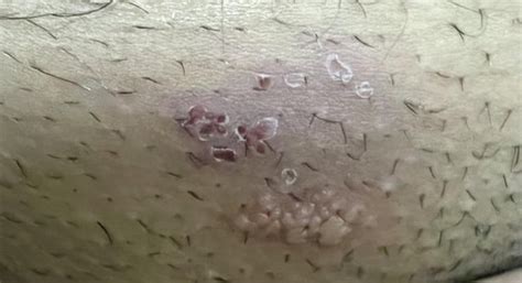Folliculitis Genital Area Folliculitis Like Lesions On The Legs