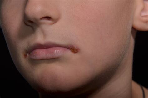 Angular Cheilitis Scars