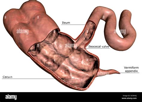 Ileocecal Resection Cecum Cancer An Overview Sciencedirect Topics