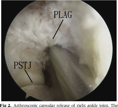 Figure 2 From Arthroscopic Capsular Release Of The Ankle Joint