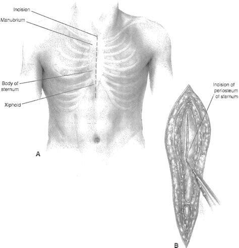 Transsternal Thymectomy Operative Techniques In Thoracic And