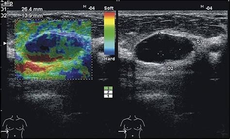 Breast Elastography A New Paradigm In Diagnostic Breast Imaging Applied Radiology