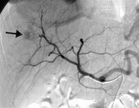 Impact Of Multidetector Ct Hepatic Arteriography On The Planning Of