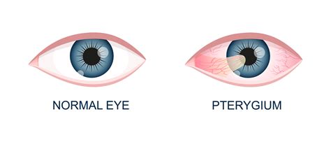 Pterygium Surgery Cape Town Dr Marianthy Vayanos