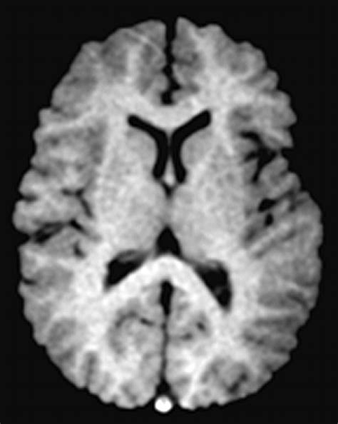 Diffusion Tensor Mr Imaging Of Normal Brain Maturation A Guide To
