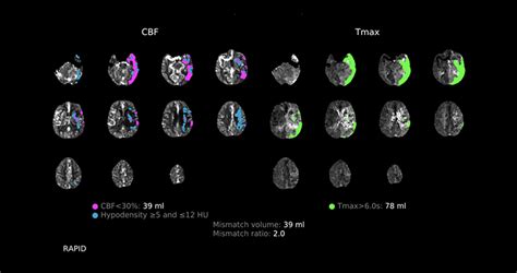 Ct Perfusion Image Analysis Software For Stroke Rapidai