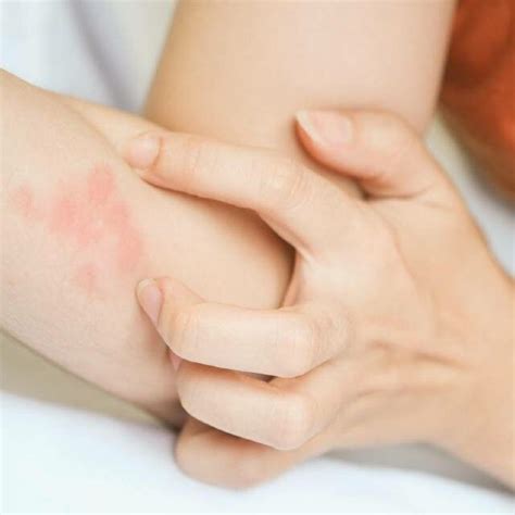 Micose No Couro Cabeludo O Que é Sintomas E Tratamentos Mundoboaforma