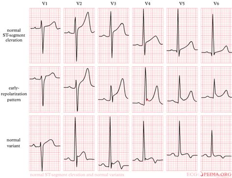 Early Repolarization