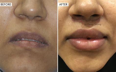 Celebrities With Lip Lifts 60 Photos Moonagedaydream Film