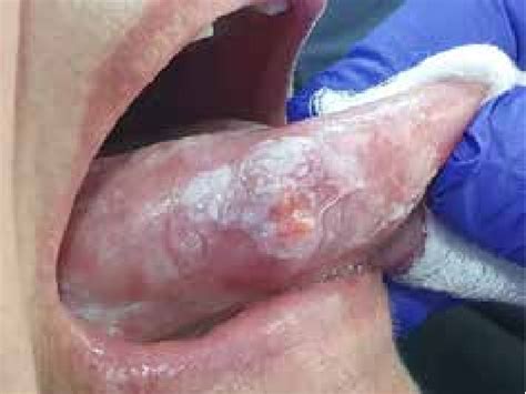 Sex Distribution In Percentage Of Oral Squamous Cell Carcinoma