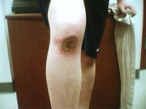 6th Degree Burns